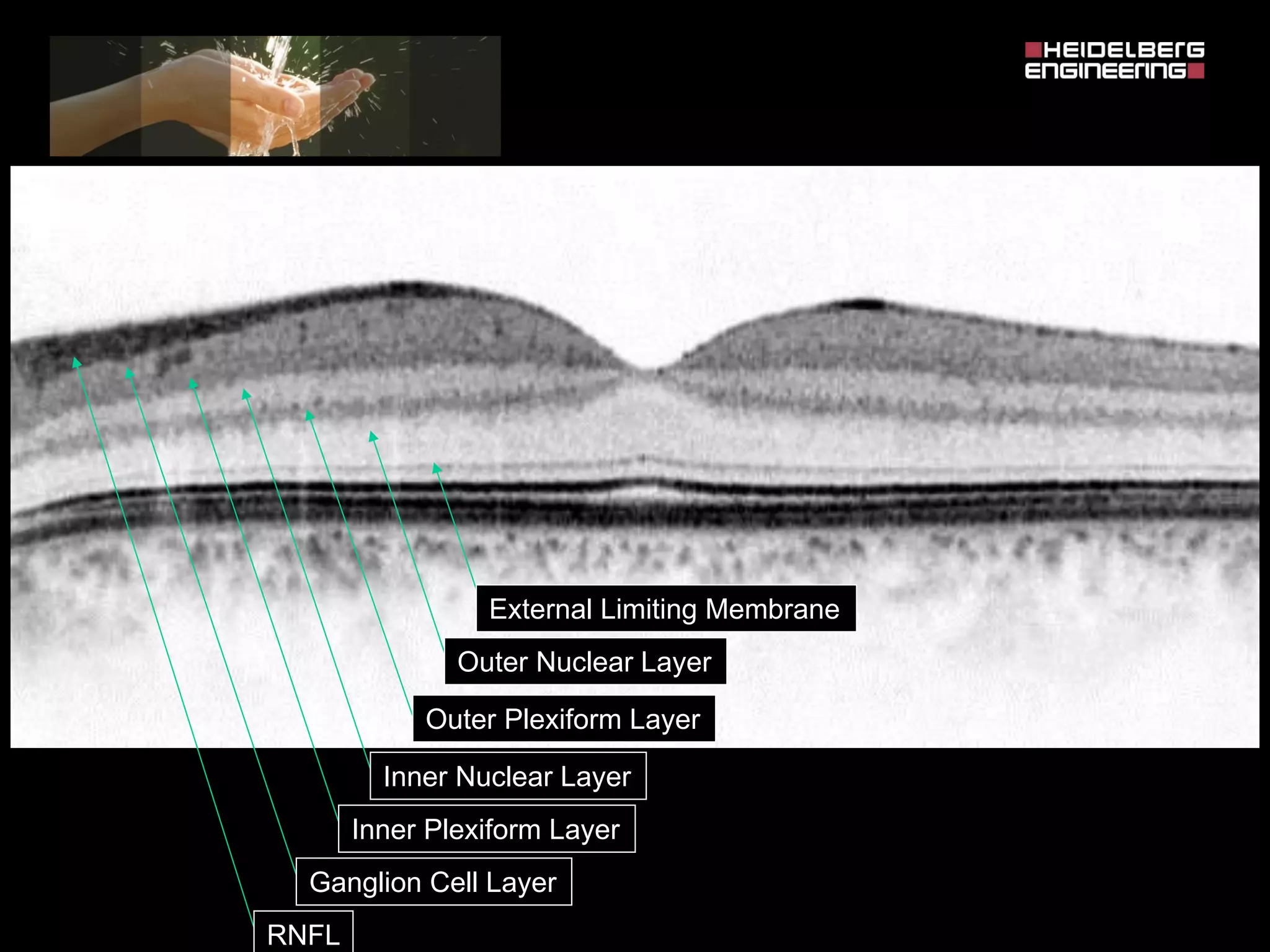 Spectralis oct normal anatomy & systematic interpretation. | PDF