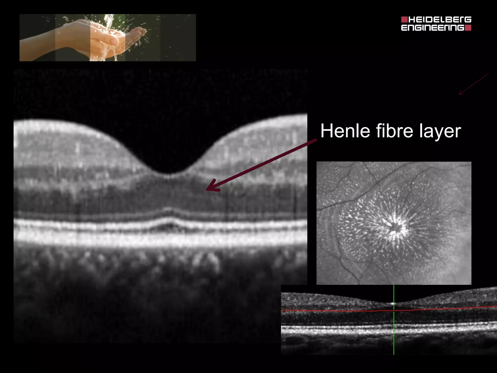 Spectralis oct normal anatomy & systematic interpretation. | PDF