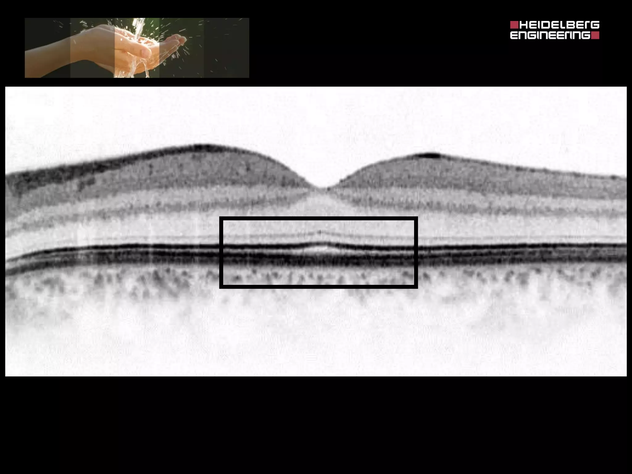 Spectralis oct normal anatomy & systematic interpretation. | PDF