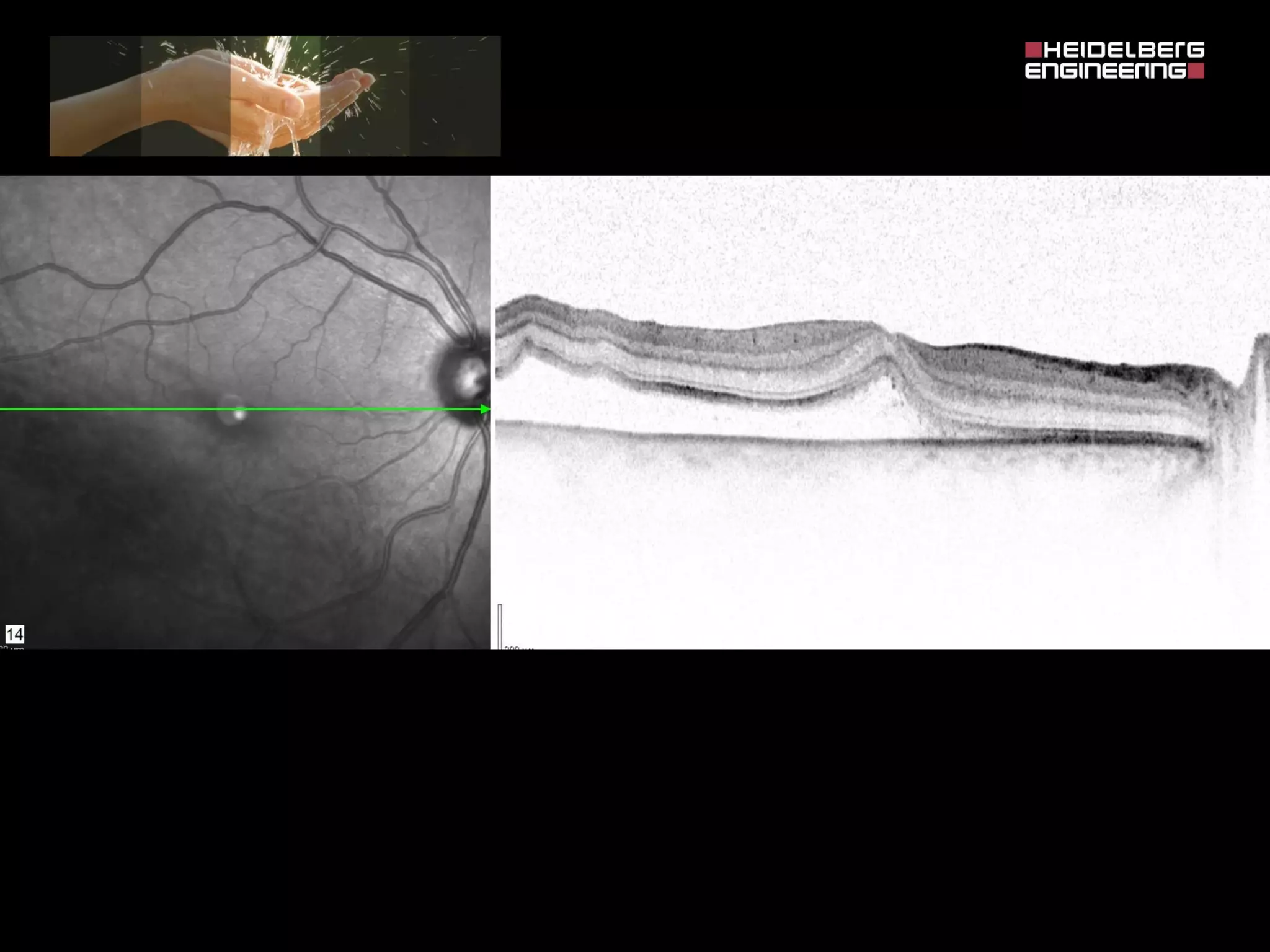 Spectralis oct normal anatomy & systematic interpretation. | PDF