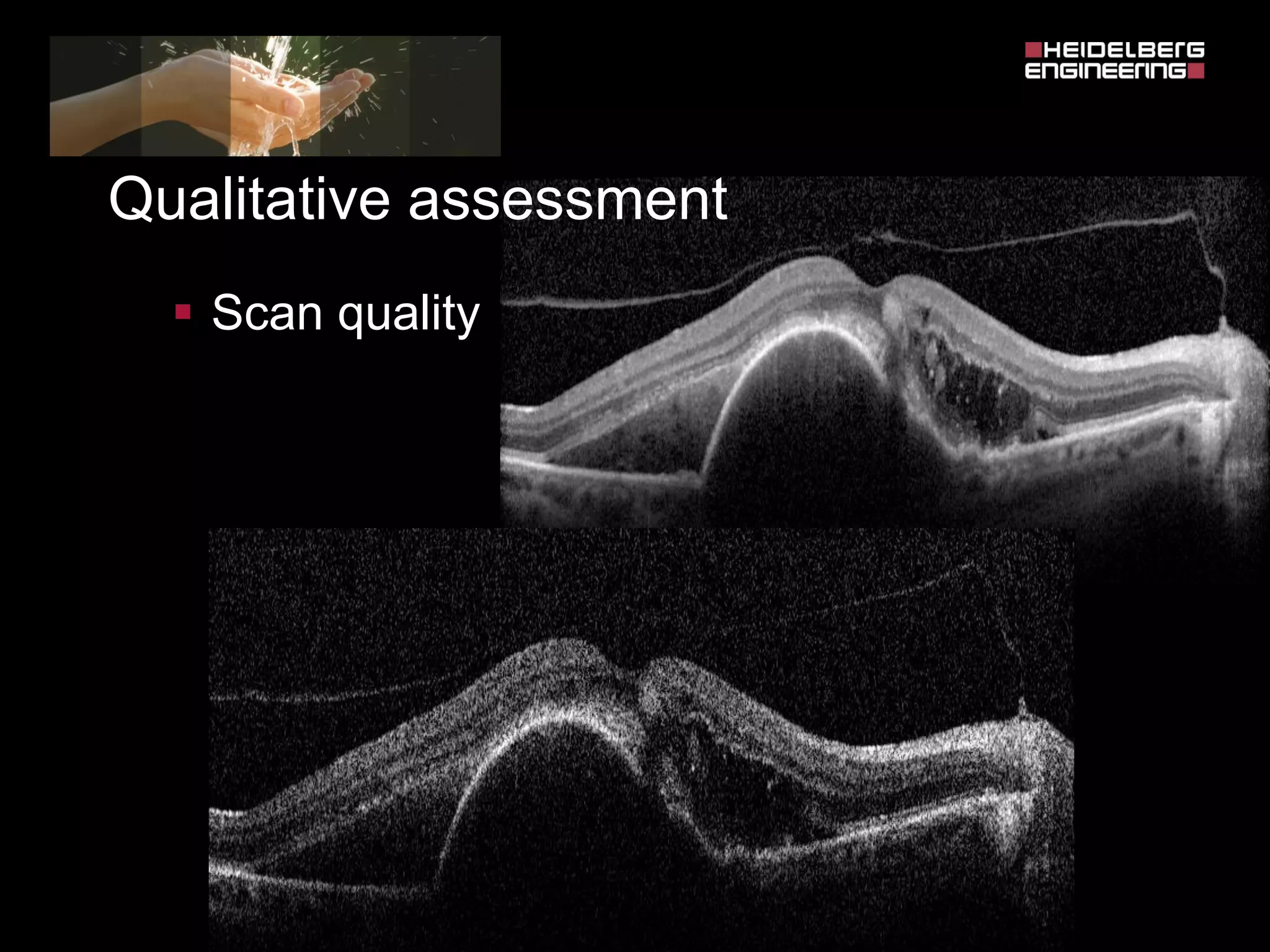 Spectralis oct normal anatomy & systematic interpretation. | PDF