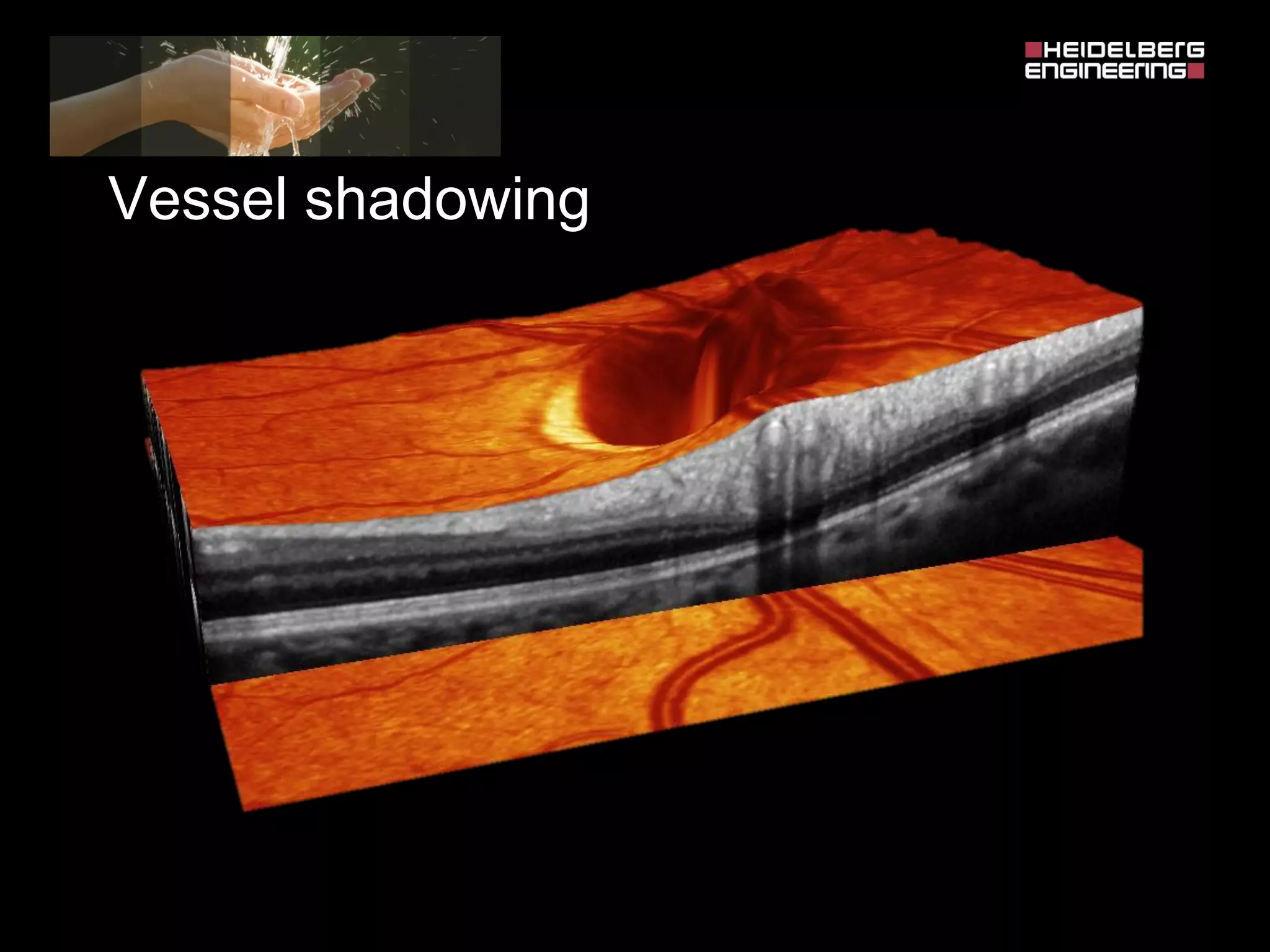 Spectralis oct normal anatomy & systematic interpretation. | PDF