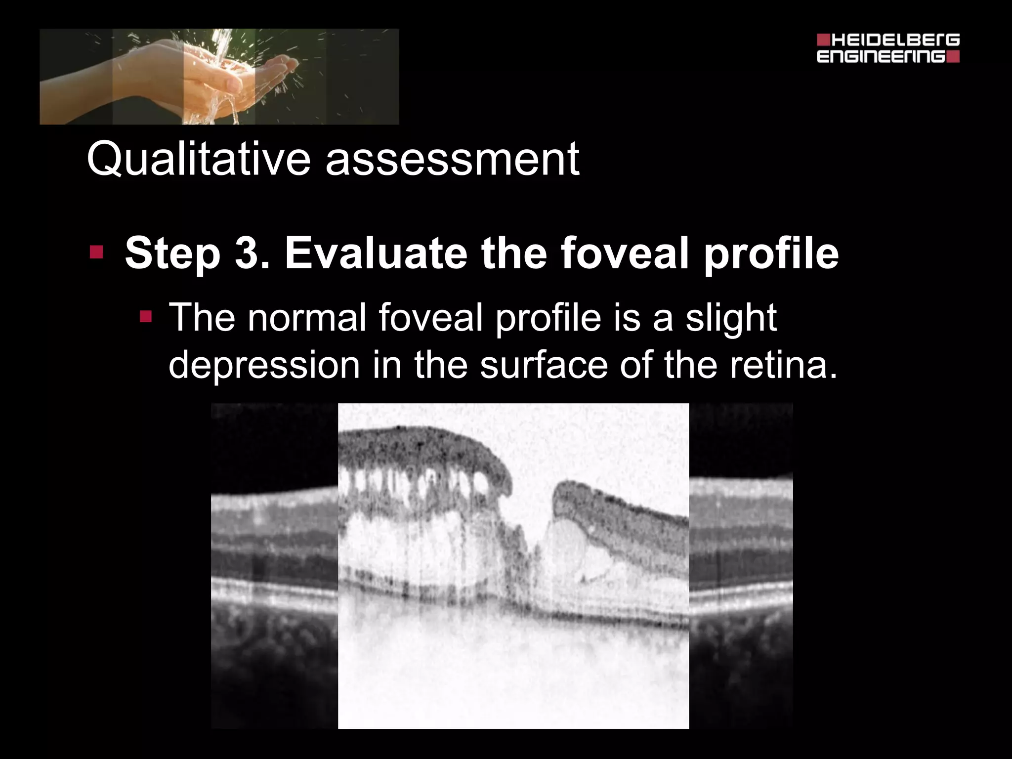 Spectralis oct normal anatomy & systematic interpretation. | PDF