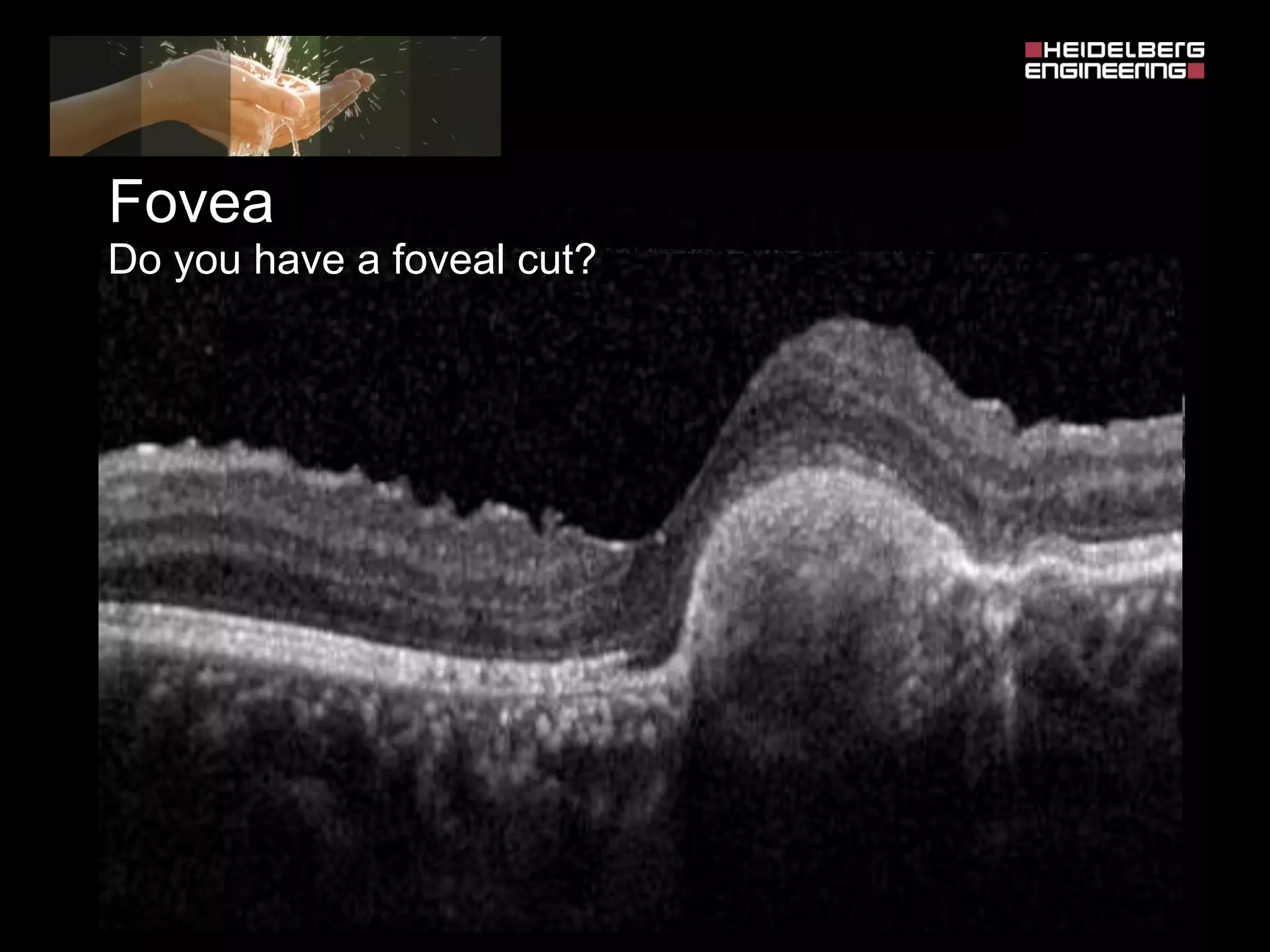 Spectralis oct normal anatomy & systematic interpretation. | PDF