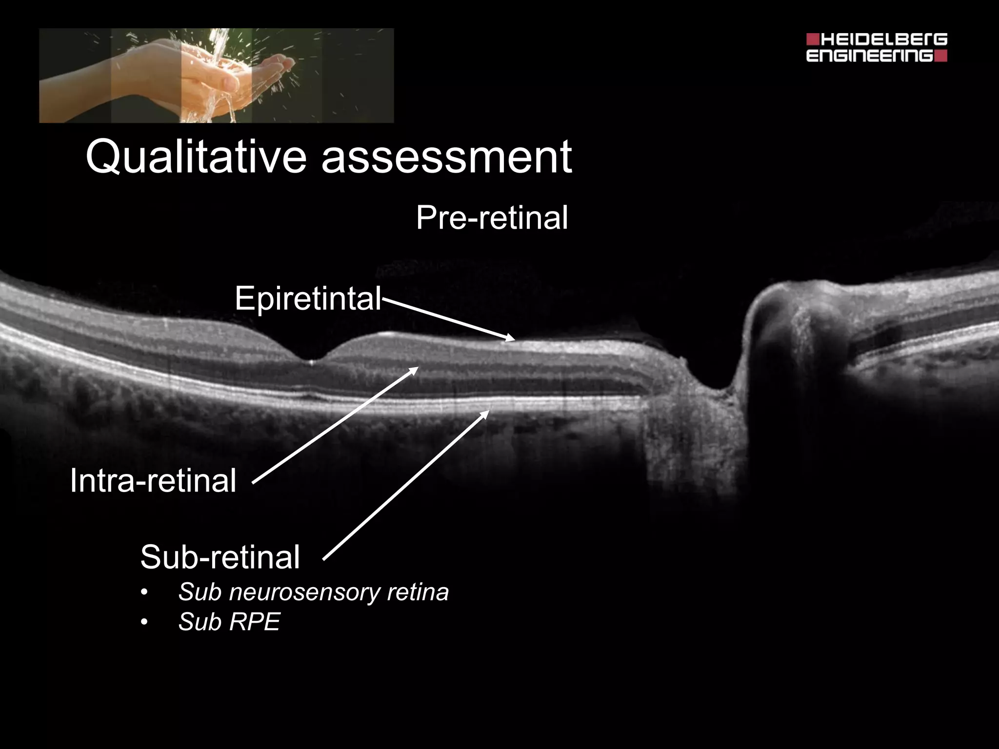 Spectralis oct normal anatomy & systematic interpretation. | PDF
