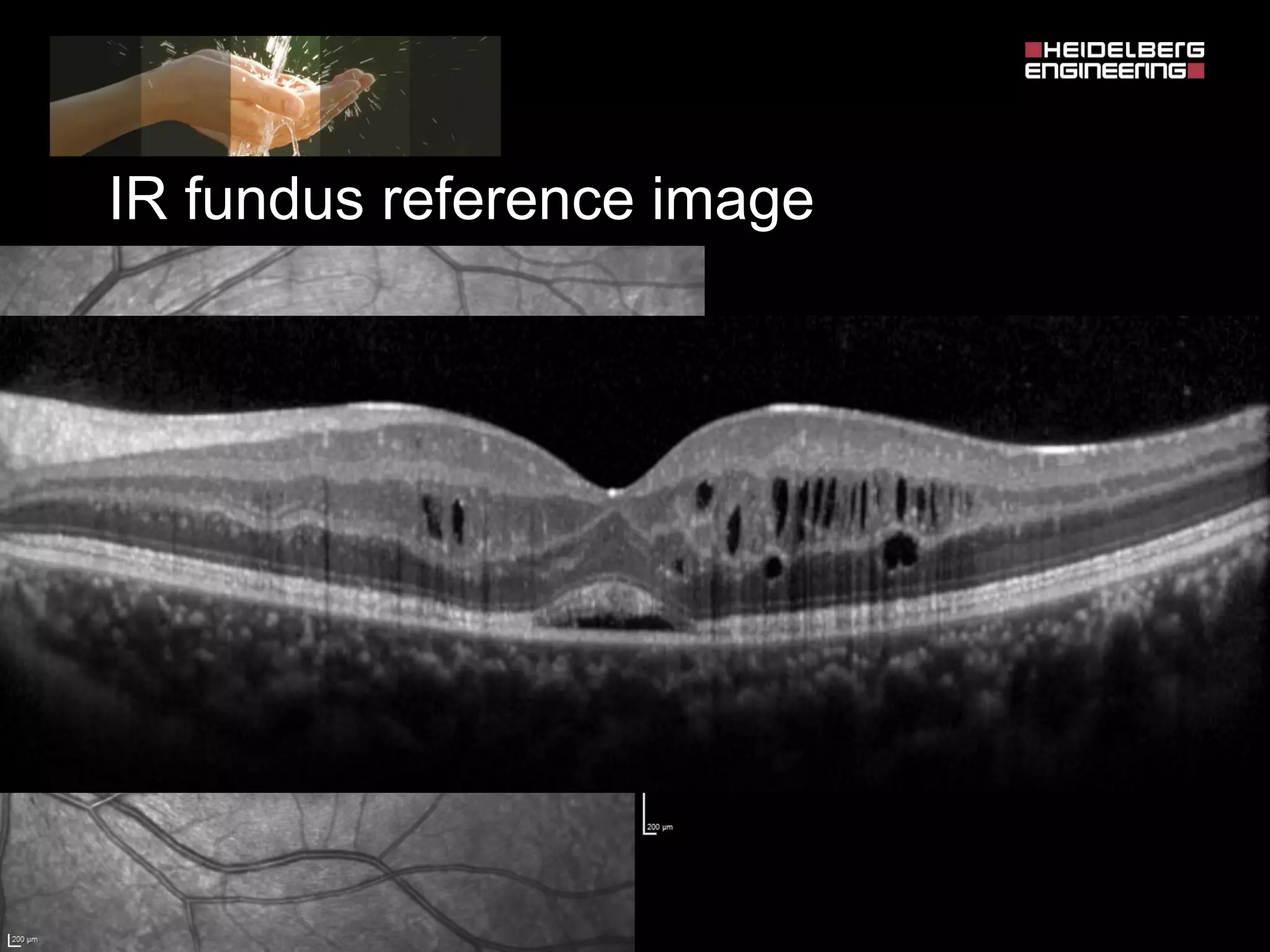 Spectralis oct normal anatomy & systematic interpretation. | PDF