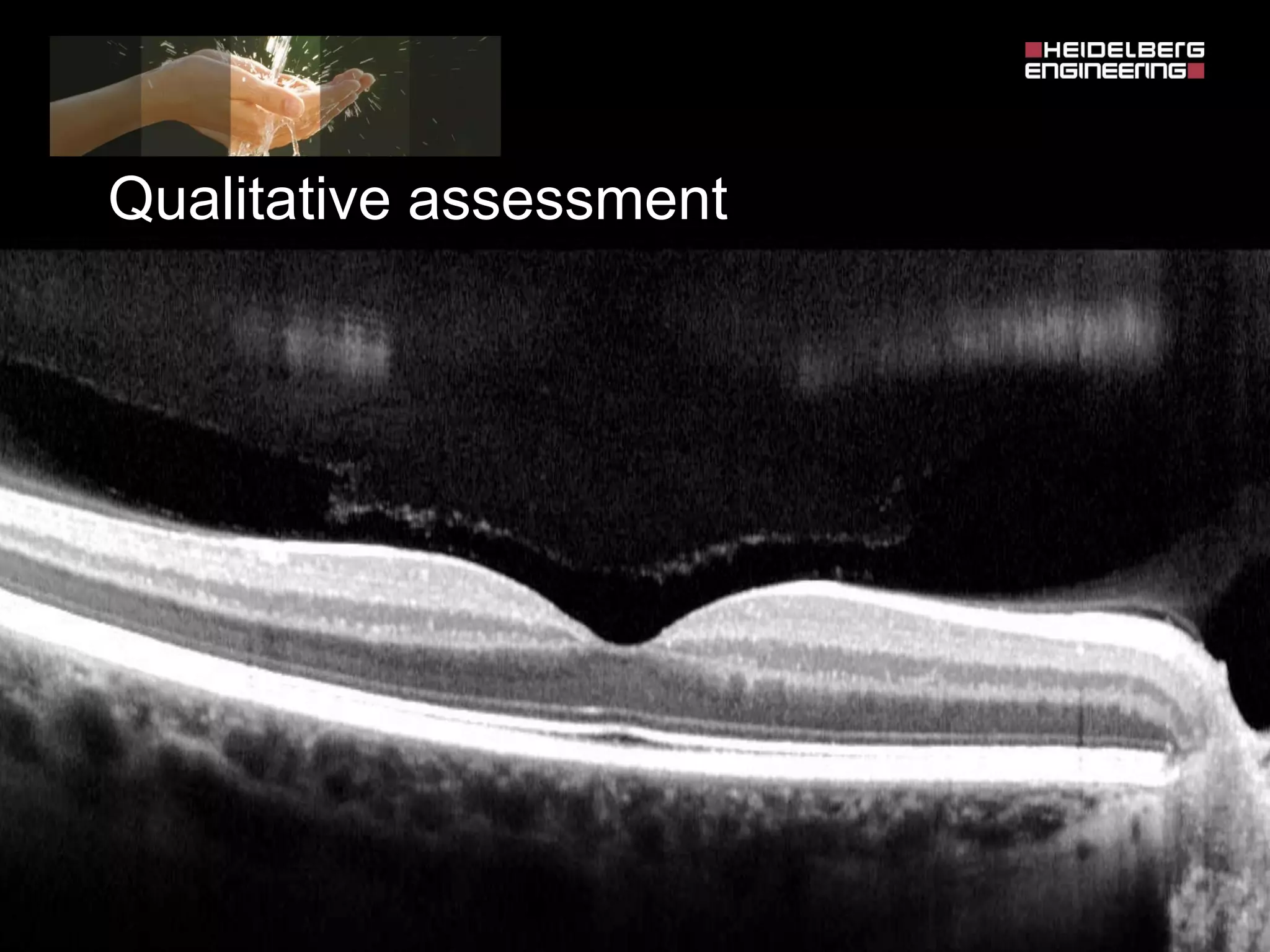 Spectralis oct normal anatomy & systematic interpretation. | PDF
