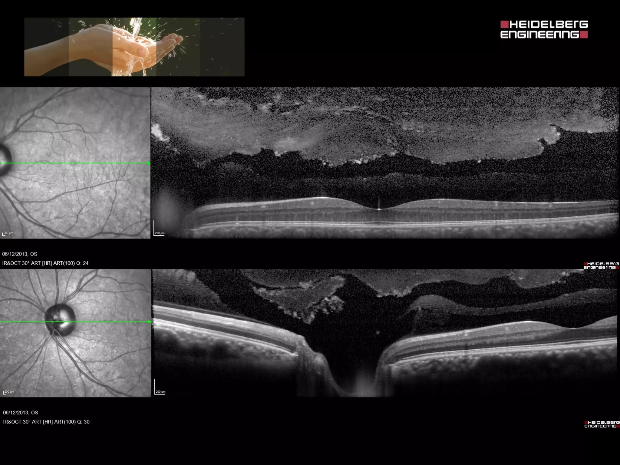 Spectralis oct normal anatomy & systematic interpretation. | PDF