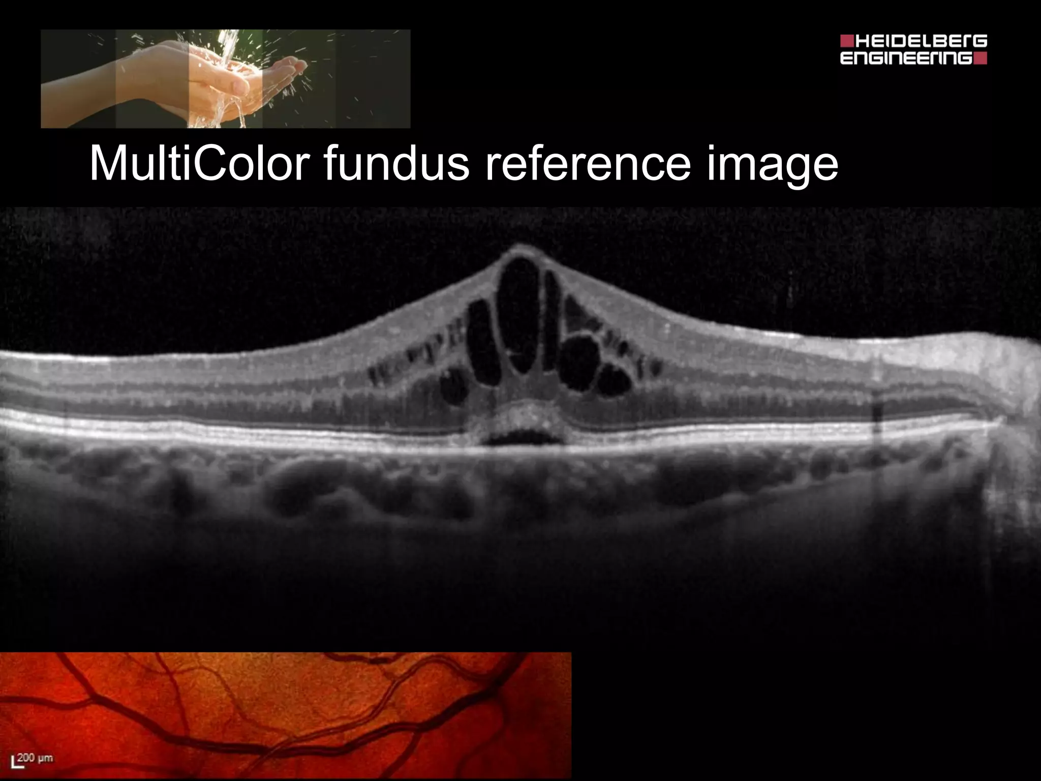 Spectralis oct normal anatomy & systematic interpretation. | PDF