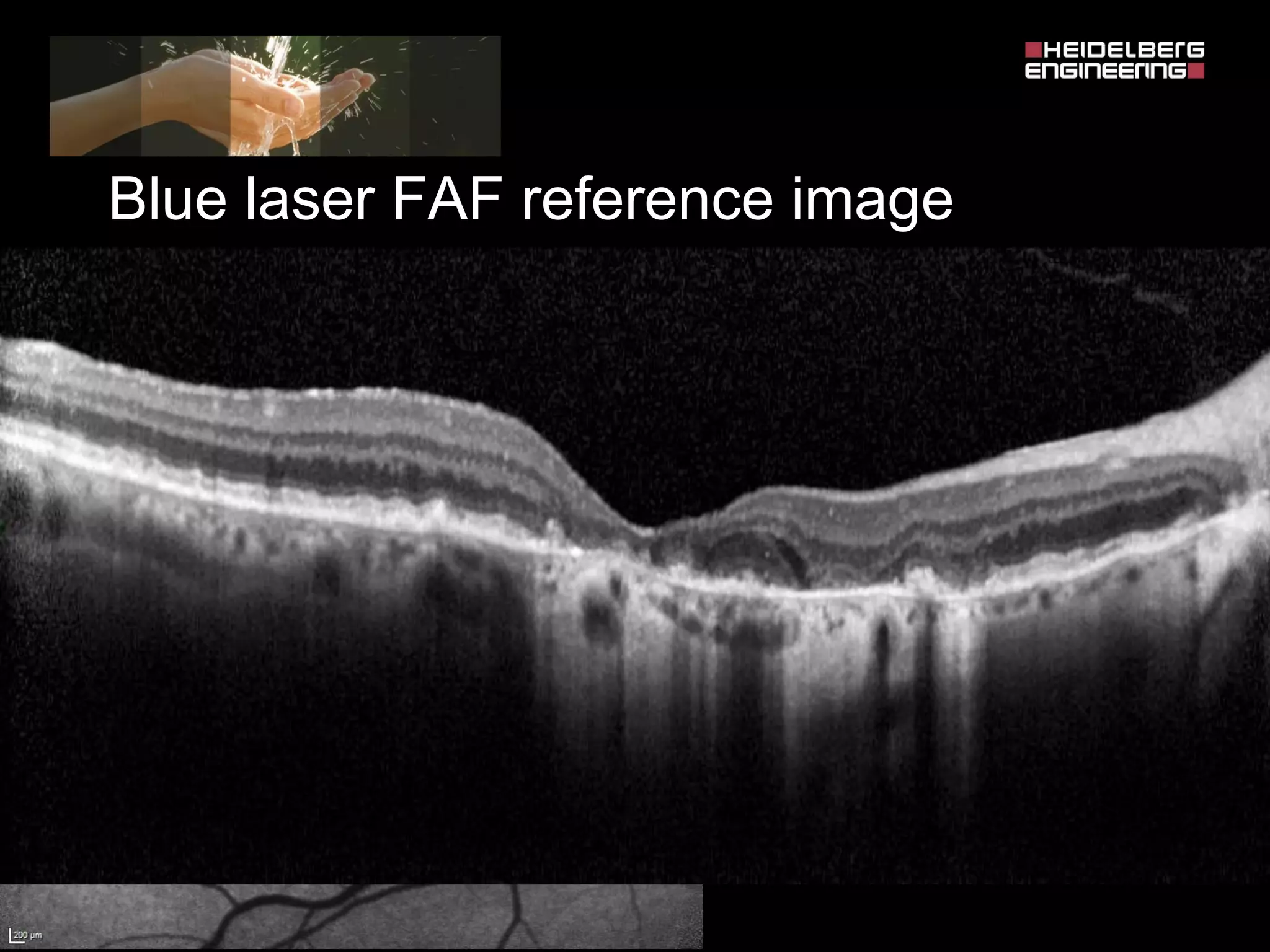 Spectralis oct normal anatomy & systematic interpretation. | PDF