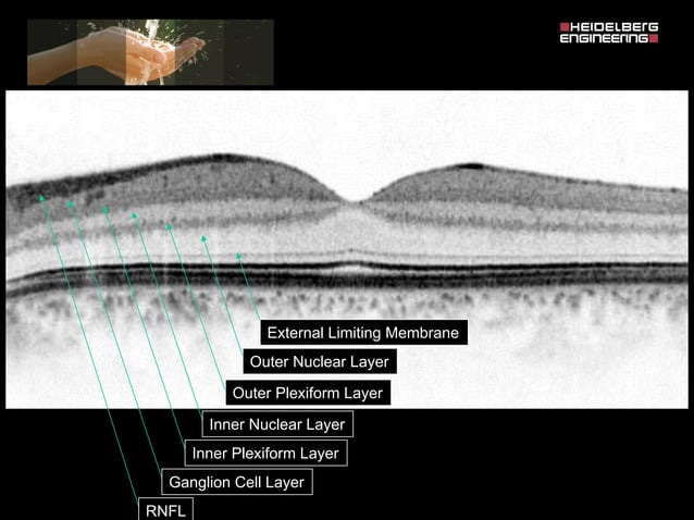 Spectralis oct normal anatomy & systematic interpretation. | PDF | Eye ...