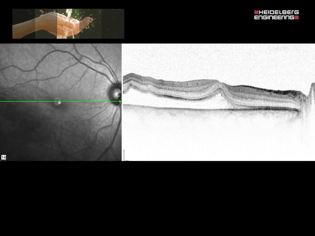 Spectralis oct normal anatomy & systematic interpretation. | PDF | Eye ...