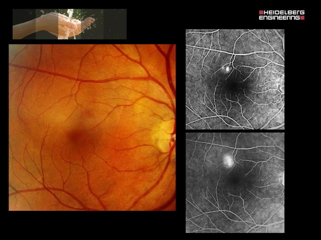 Spectralis oct normal anatomy & systematic interpretation. | PDF | Eye ...