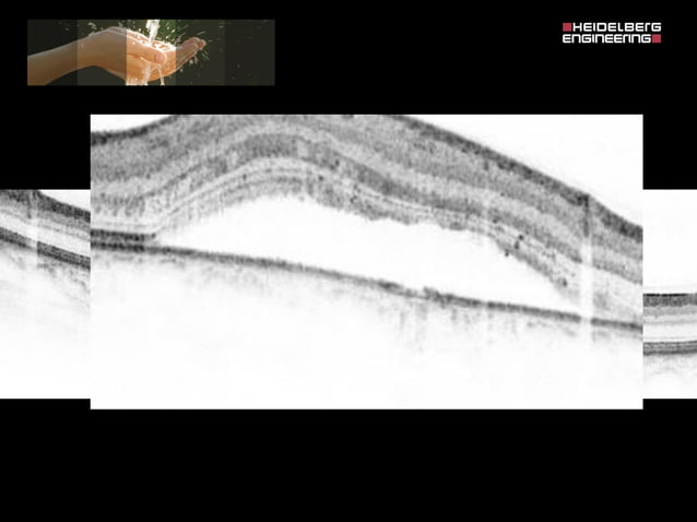 Spectralis oct normal anatomy & systematic interpretation. | PDF | Eye ...