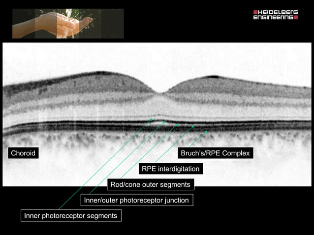 Spectralis oct normal anatomy & systematic interpretation. | PDF | Eye ...
