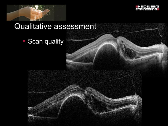 Spectralis oct normal anatomy & systematic interpretation. | PDF | Eye ...