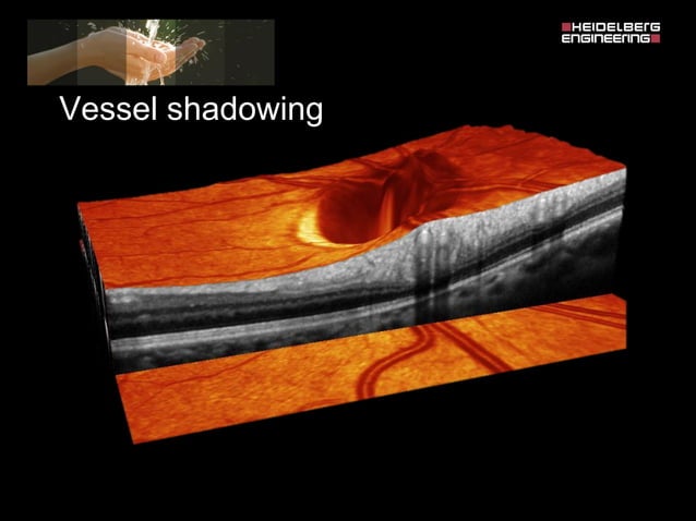 Spectralis oct normal anatomy & systematic interpretation. | PDF | Eye ...
