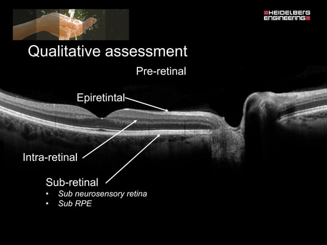 Spectralis oct normal anatomy & systematic interpretation. | PDF | Eye ...