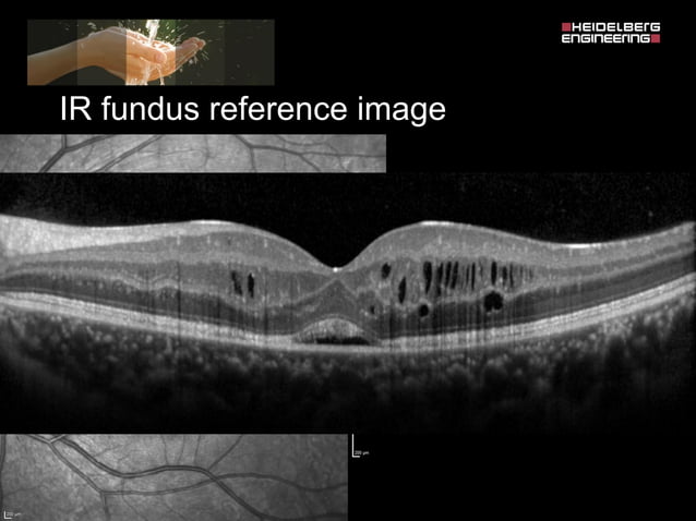 Spectralis oct normal anatomy & systematic interpretation. | PDF | Eye ...