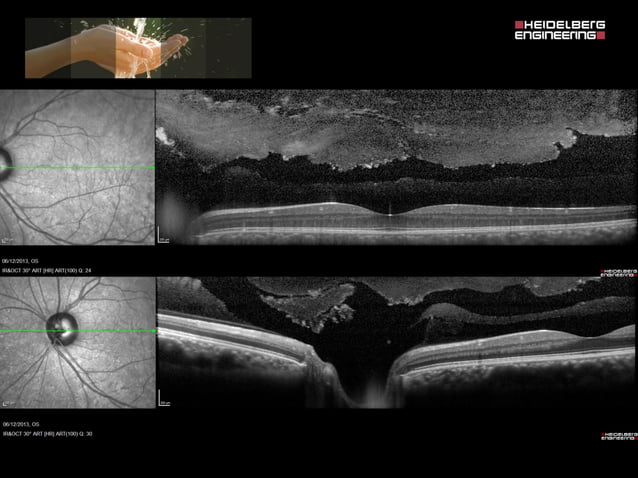 Spectralis oct normal anatomy & systematic interpretation. | PDF | Eye ...