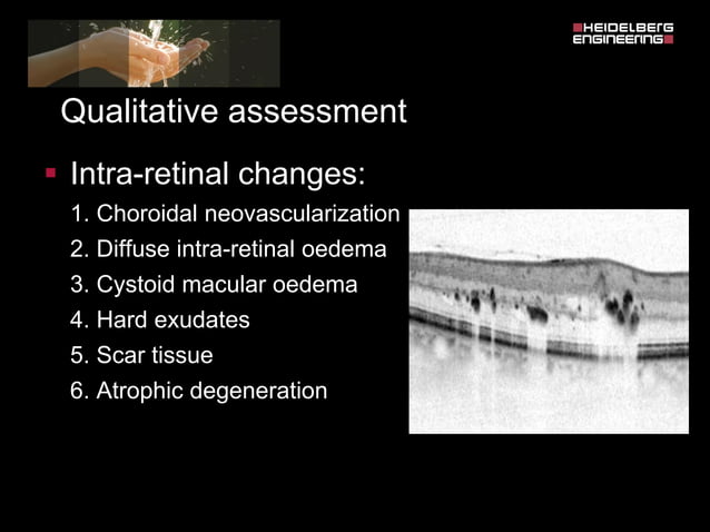 Spectralis oct normal anatomy & systematic interpretation. | PDF | Eye ...