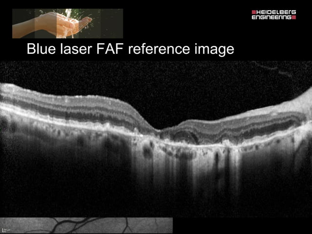 Spectralis oct normal anatomy & systematic interpretation. | PPT