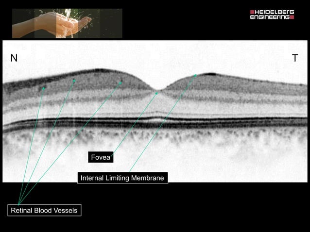 Spectralis oct normal anatomy & systematic interpretation. | PDF | Eye ...