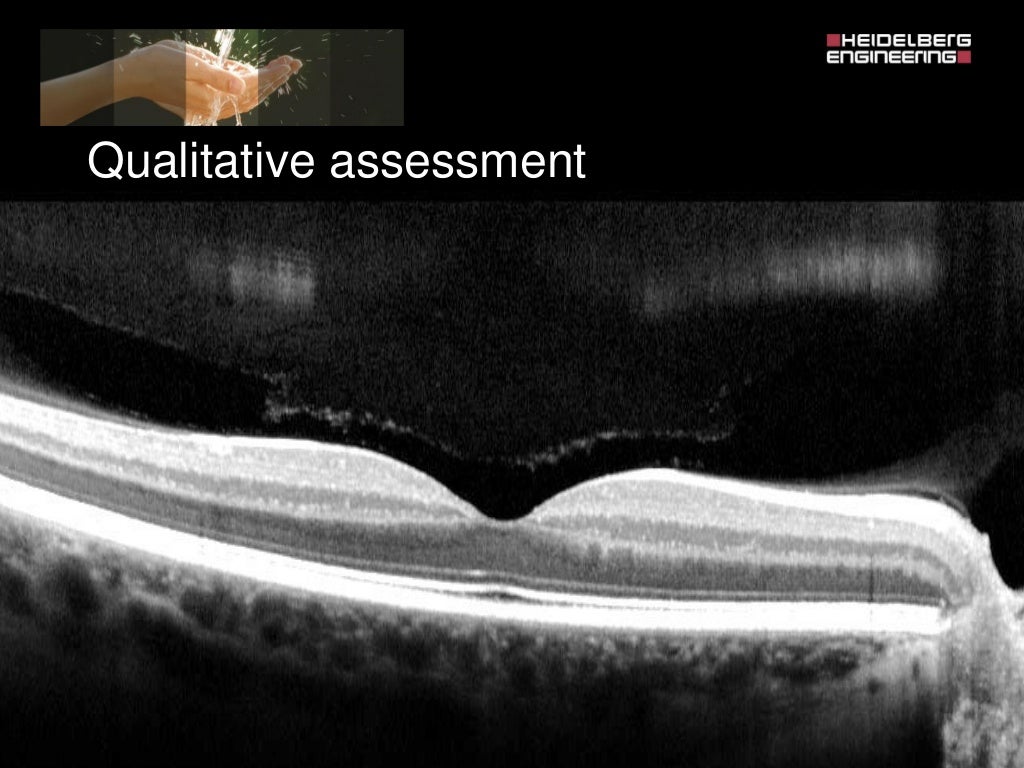 Spectralis oct normal anatomy & systematic interpretation.