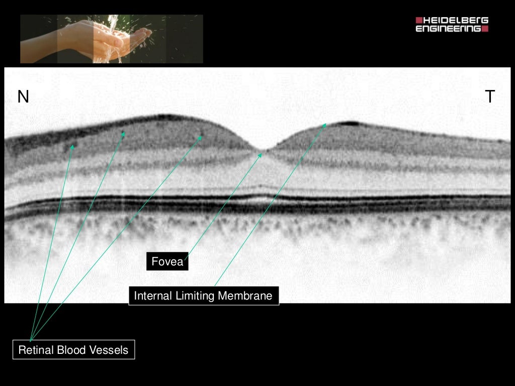 Spectralis oct normal anatomy & systematic interpretation.