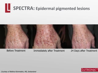 Spectra XT BA photos | PPT