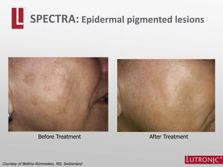 Spectra XT BA photos | PPT