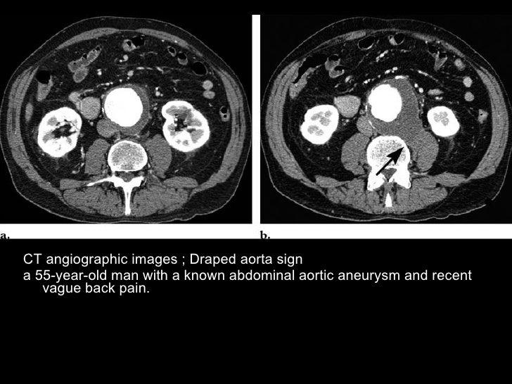 Spectrum Of Ct Findings In Rupture And Impendinging Rupture Of AAA