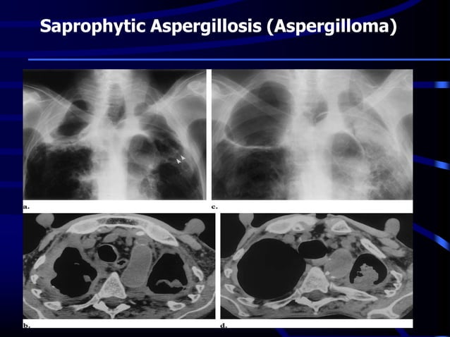 Spectrum of pulmonary asperigellosis | PDF