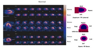 SPECT SCAN in nuclear medicine ...cardiology | PPTX