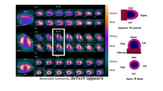 SPECT SCAN in nuclear medicine ...cardiology | PPT
