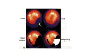 SPECT SCAN in nuclear medicine ...cardiology | PPT