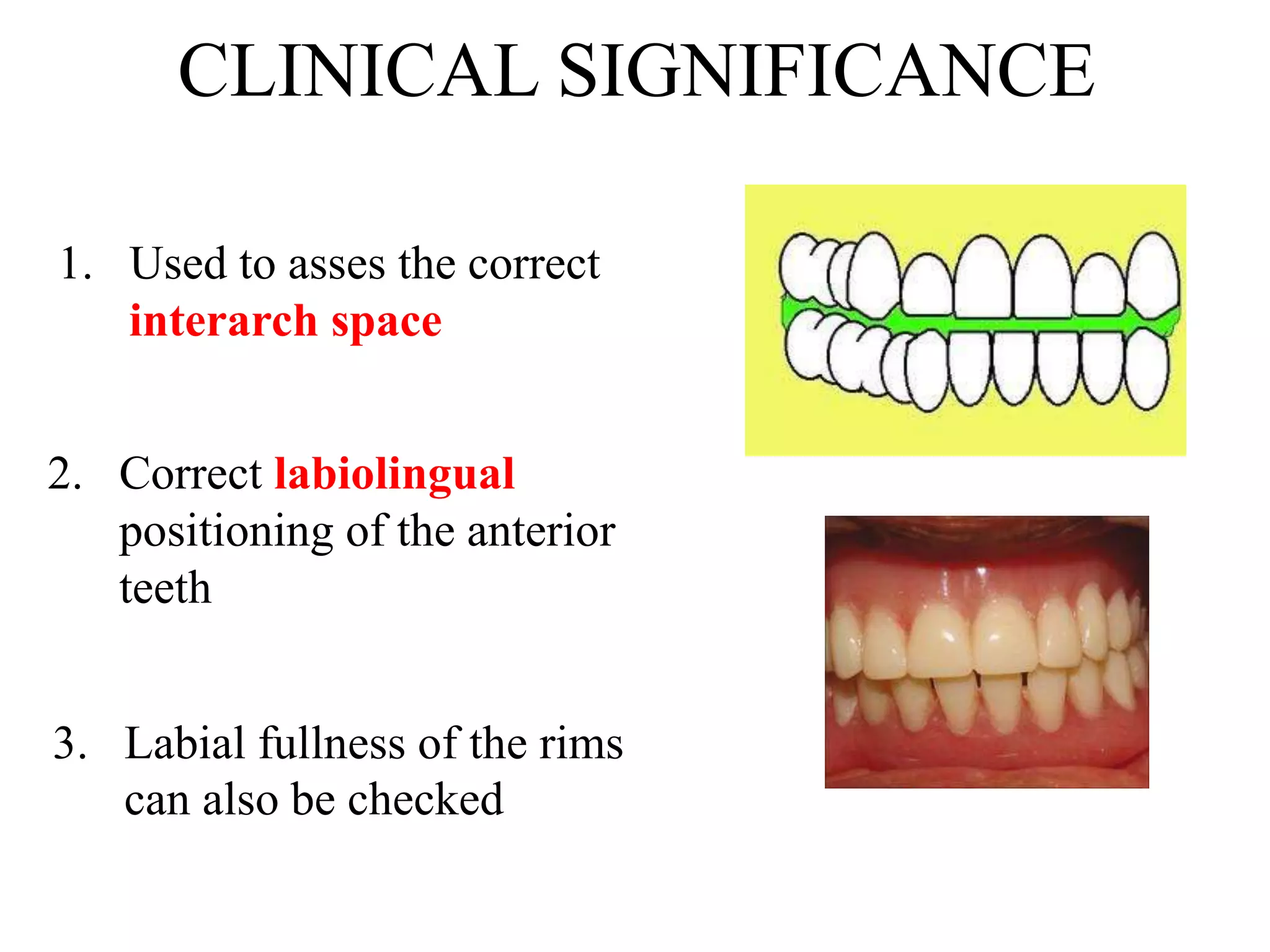 Speech consideration in complete denture | PPT