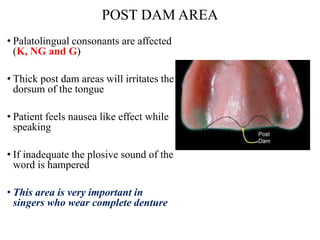 Speech consideration in complete denture | PPT