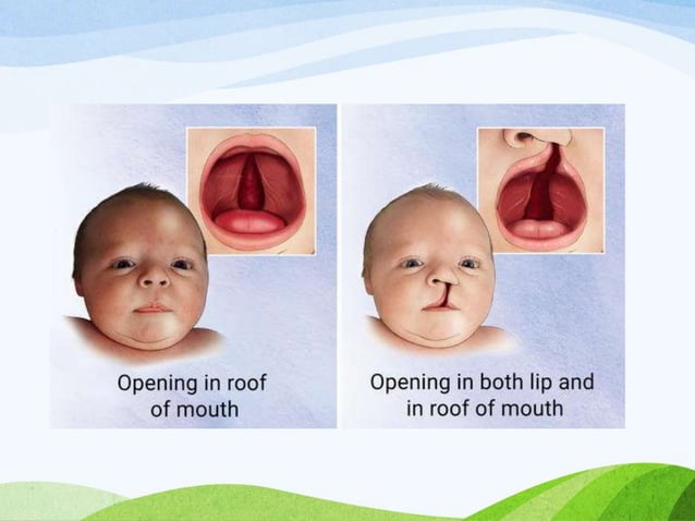 Speech defect and speech therapy | PPTX | Ear, Nose and Throat ...