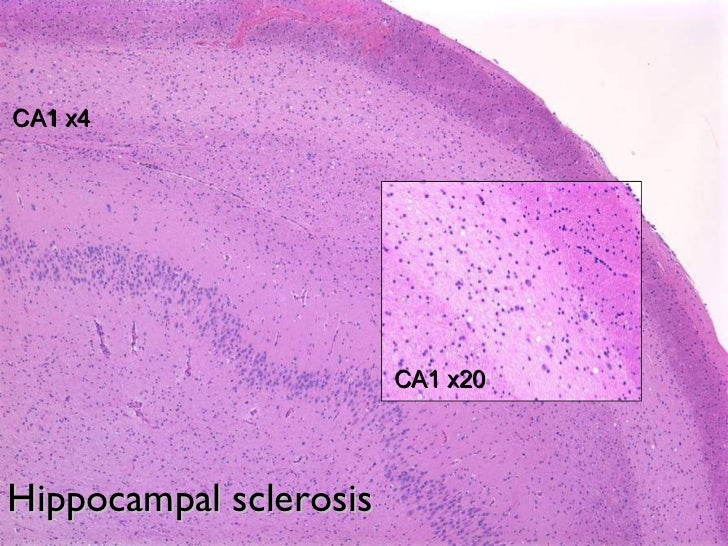 Surgical Pathology of Epilepsy