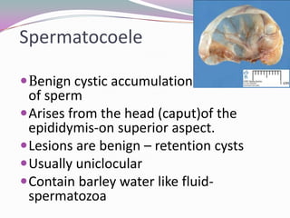Spermatocoele | PPTX