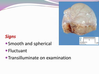 Spermatocoele | PPTX