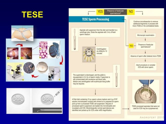 Sperm retrieval techniques | PPTX