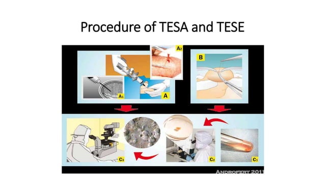 Sperm retrieval techniques | PPTX | Infertility | Reproductive Health