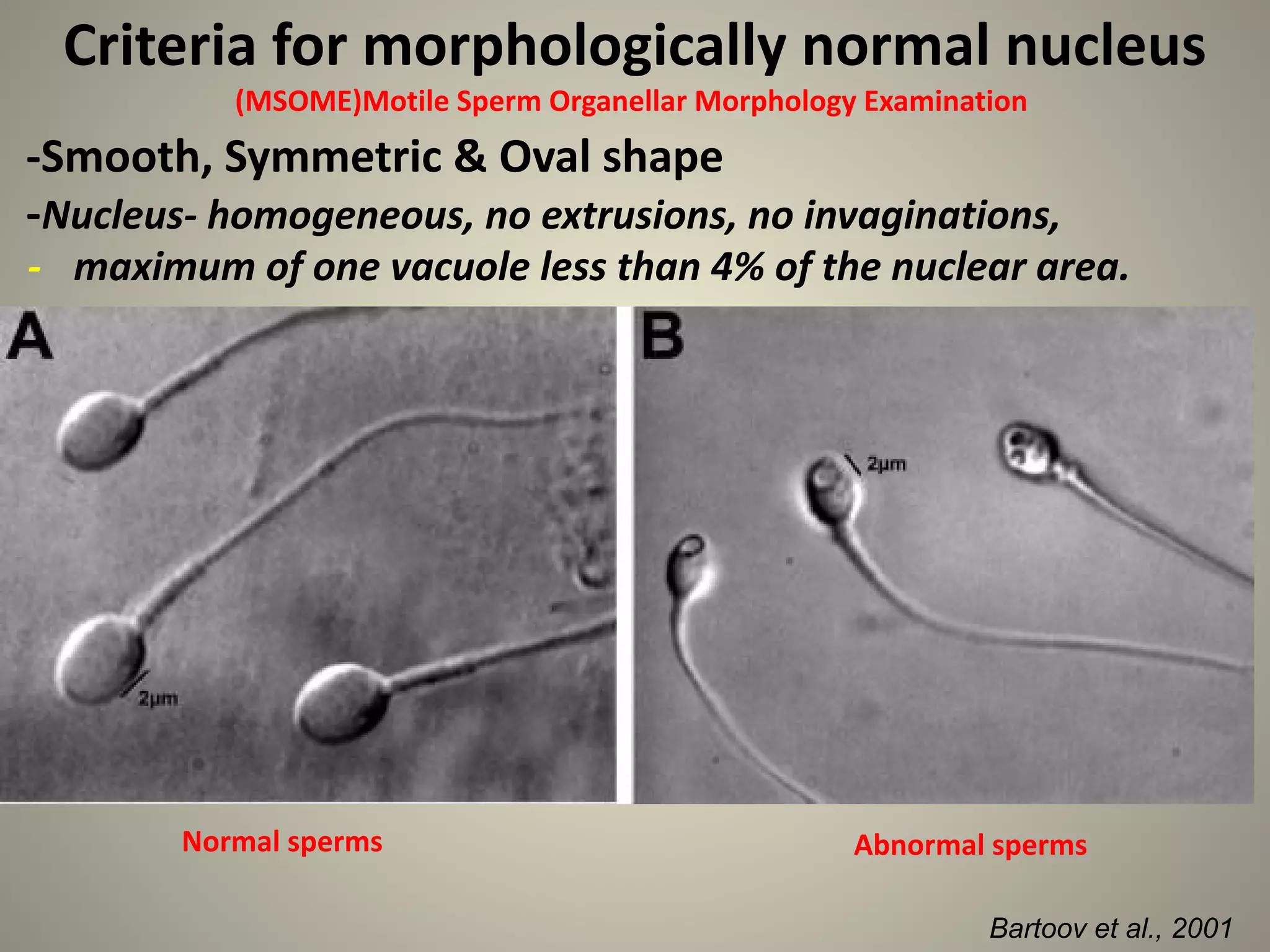 SPERM SELECTION IN ICSI | PDF