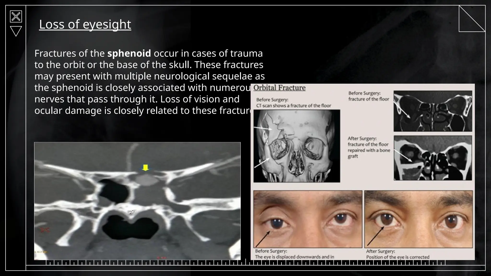 sphenoid bone anatomy and clinical anatomy | PPTX