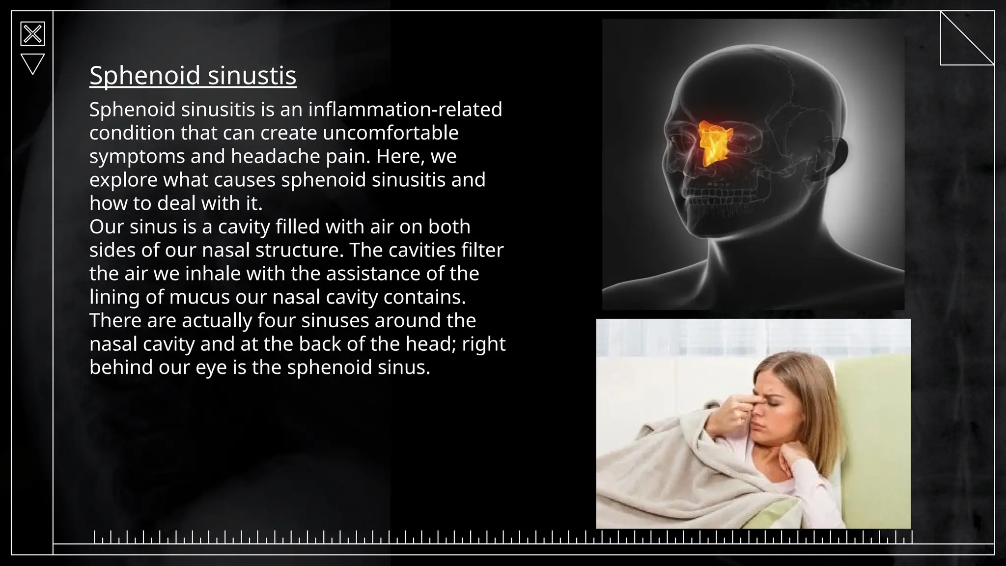 sphenoid bone anatomy and clinical anatomy | PPTX