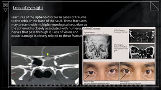 sphenoid bone anatomy and clinical anatomy | PPTX