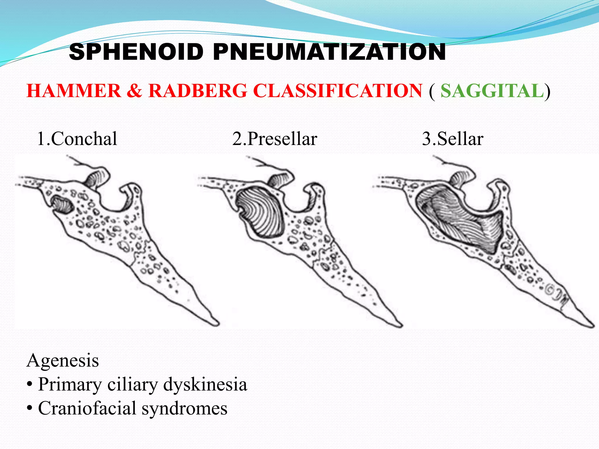 Sphenoid sinus and optic nerve | PPTX