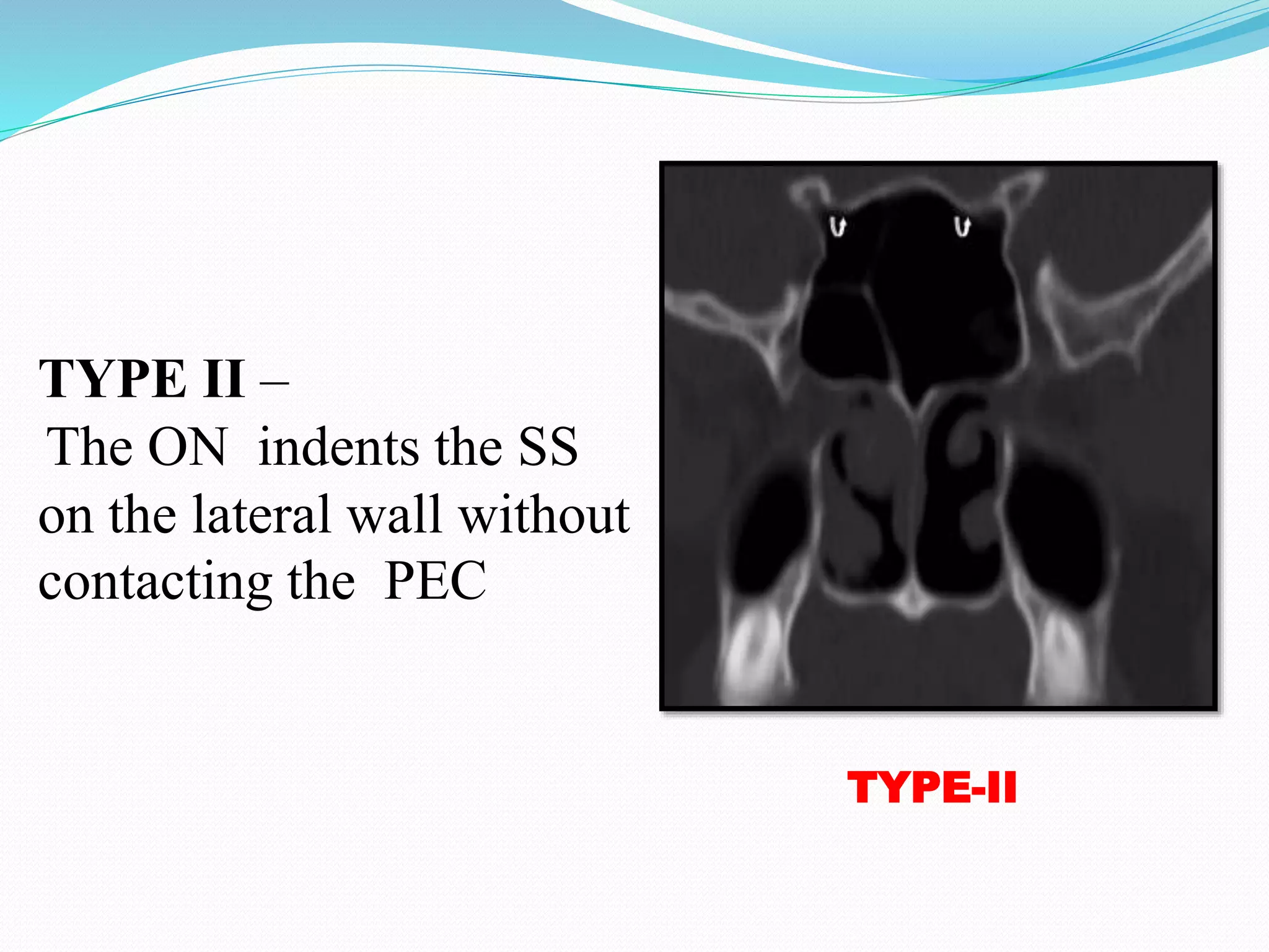 Sphenoid sinus and optic nerve | PPTX